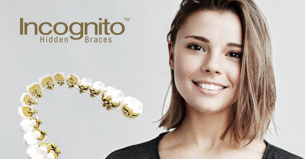 Earlwood Orthodontics Incognito Hidden Braces Orthodontics | Earlwood ...
